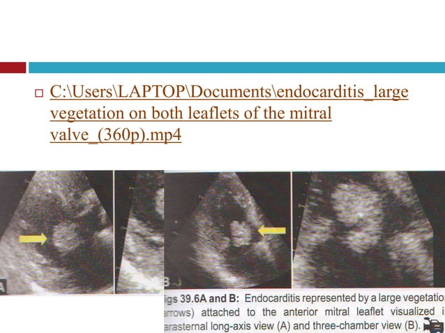 ECHOCARDIOGRAPHIC EVALUATION OF MITRAL VALVE DISEASE -MITRAL ...