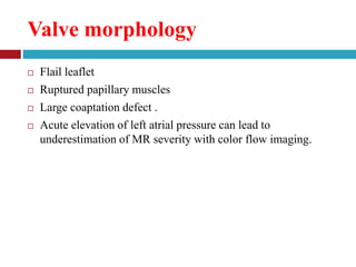ECHOCARDIOGRAPHIC EVALUATION OF MITRAL VALVE DISEASE -MITRAL ...