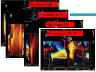 ECHOCARDIOGRAPHIC EVALUATION OF MITRAL VALVE DISEASE -MITRAL ...