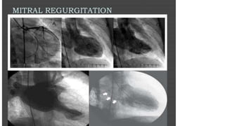 TTE for evaluation of severity of MR | PPTX