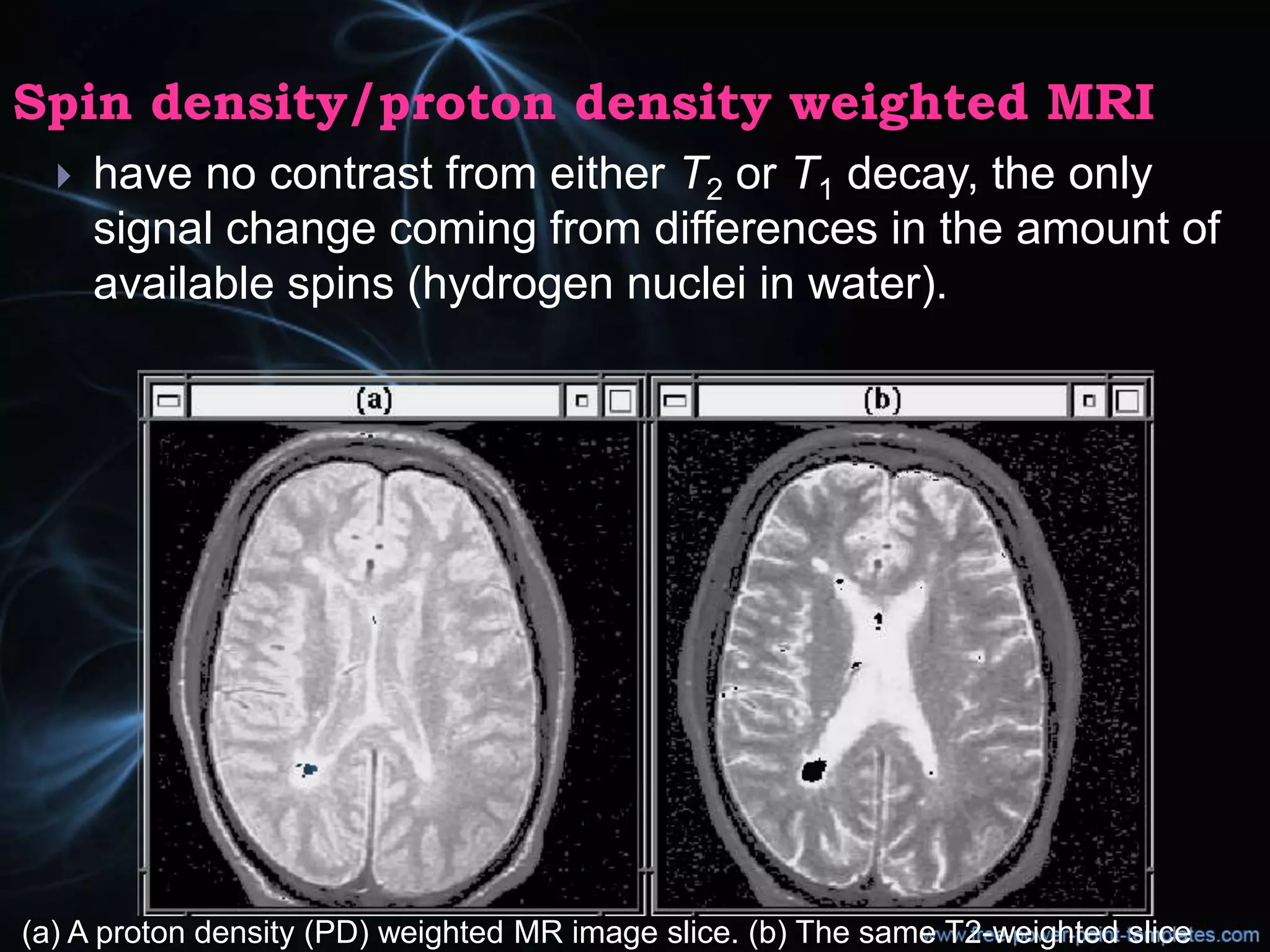 MRI (Magnetic resonance imaging) | PPTX