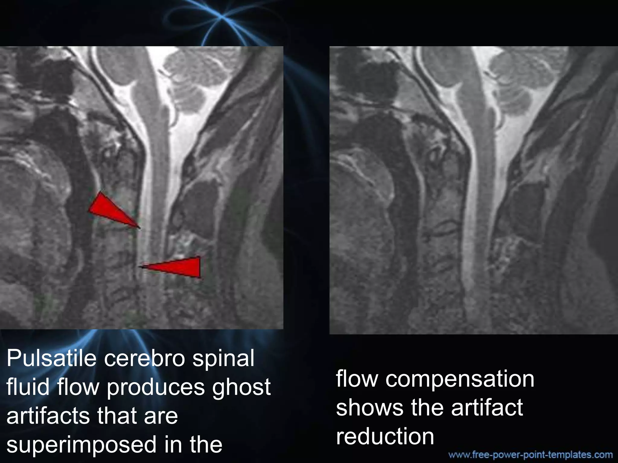 MRI (Magnetic resonance imaging) | PPTX