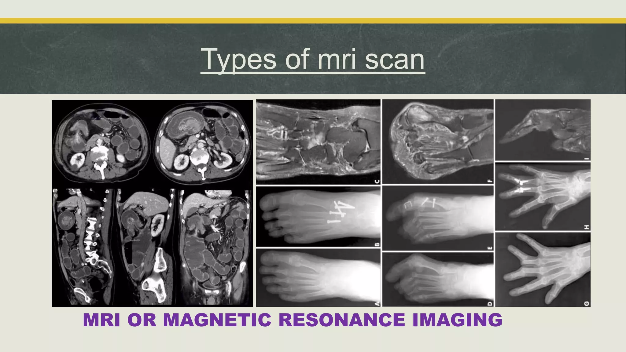 MRI | PPT