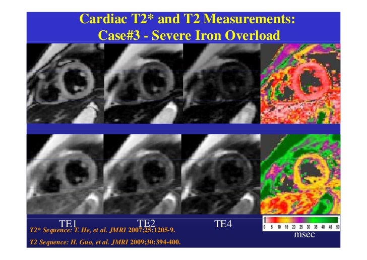 MRI-based Monitoring Tools for Iron Chelation