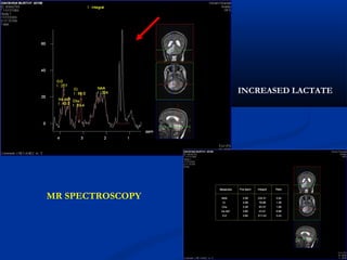 MRI Brain | PPT