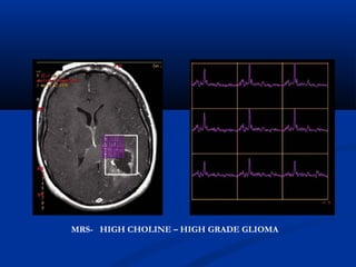 MRI Brain | PPT