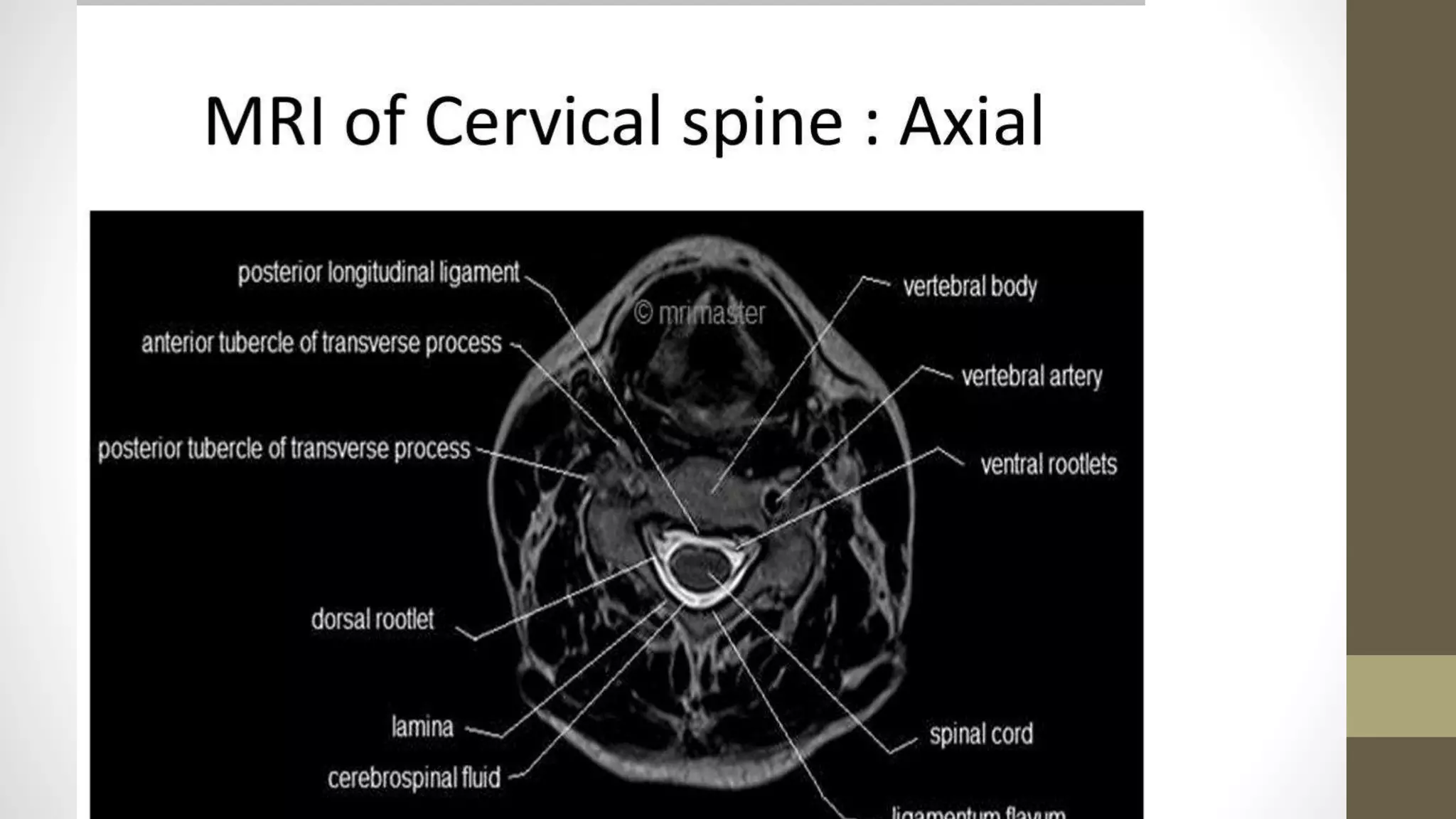 MRI-in Spine PPT.pptx