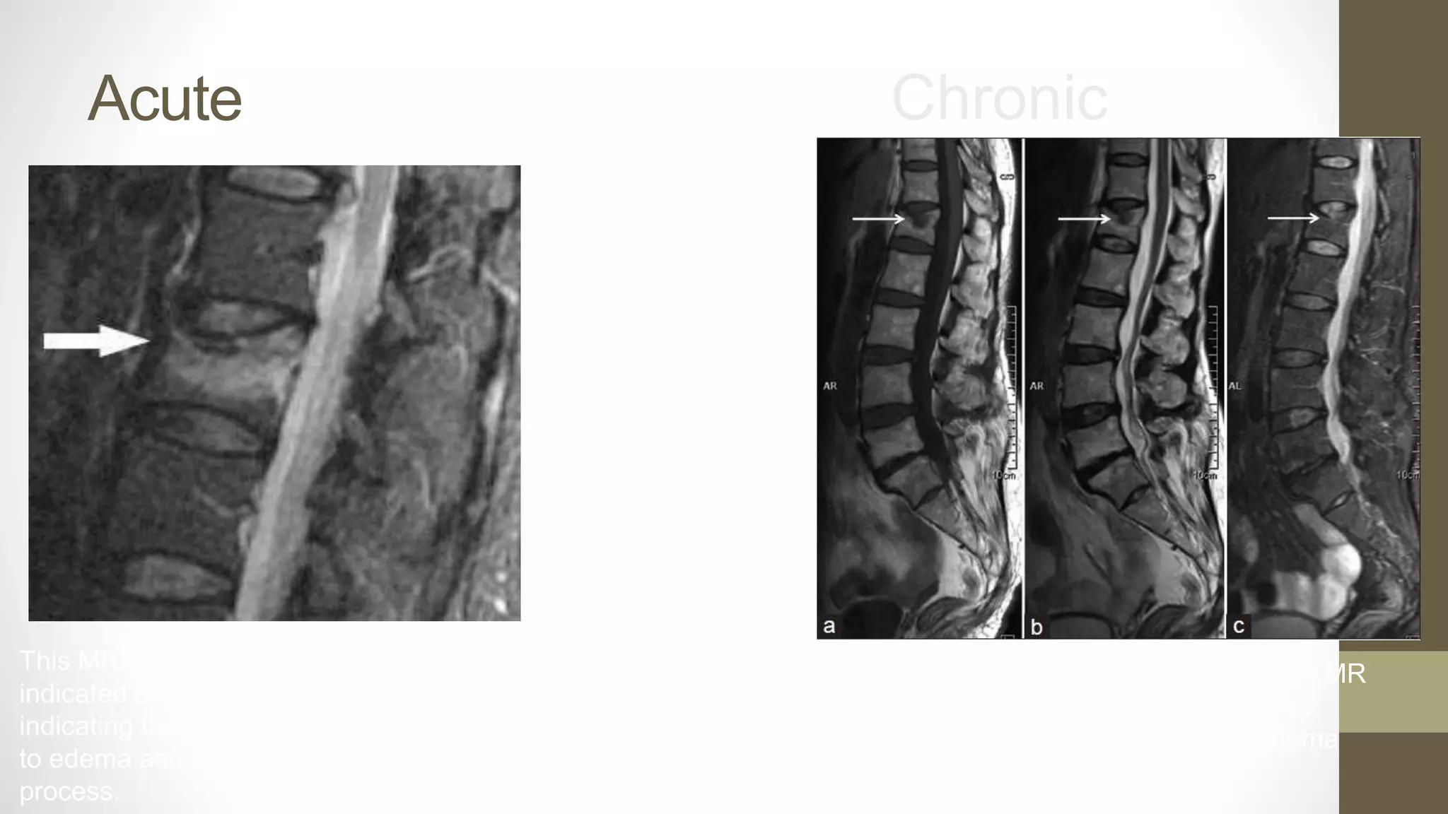 MRI-in Spine PPT.pptx