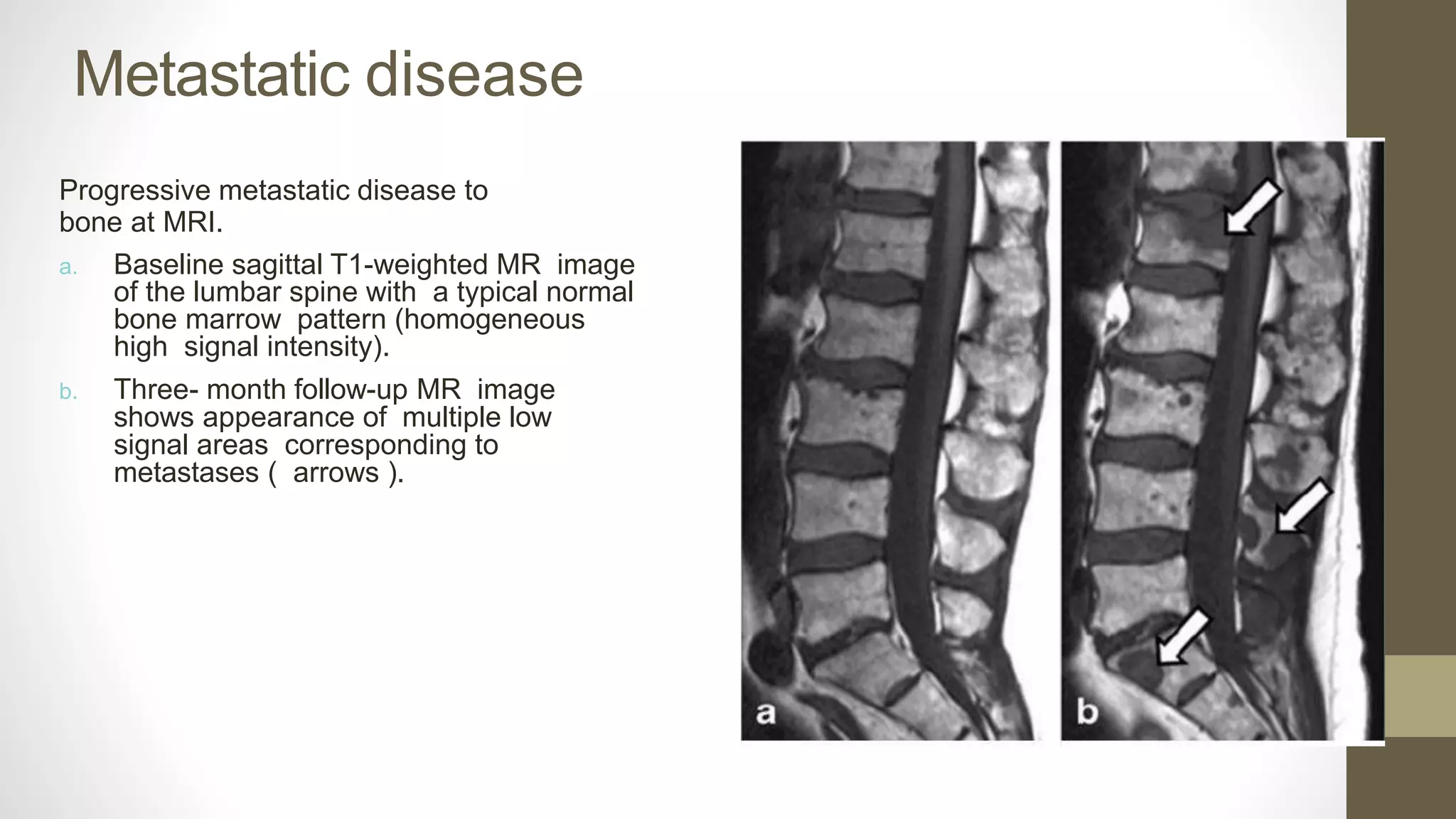 MRI-in Spine PPT.pptx