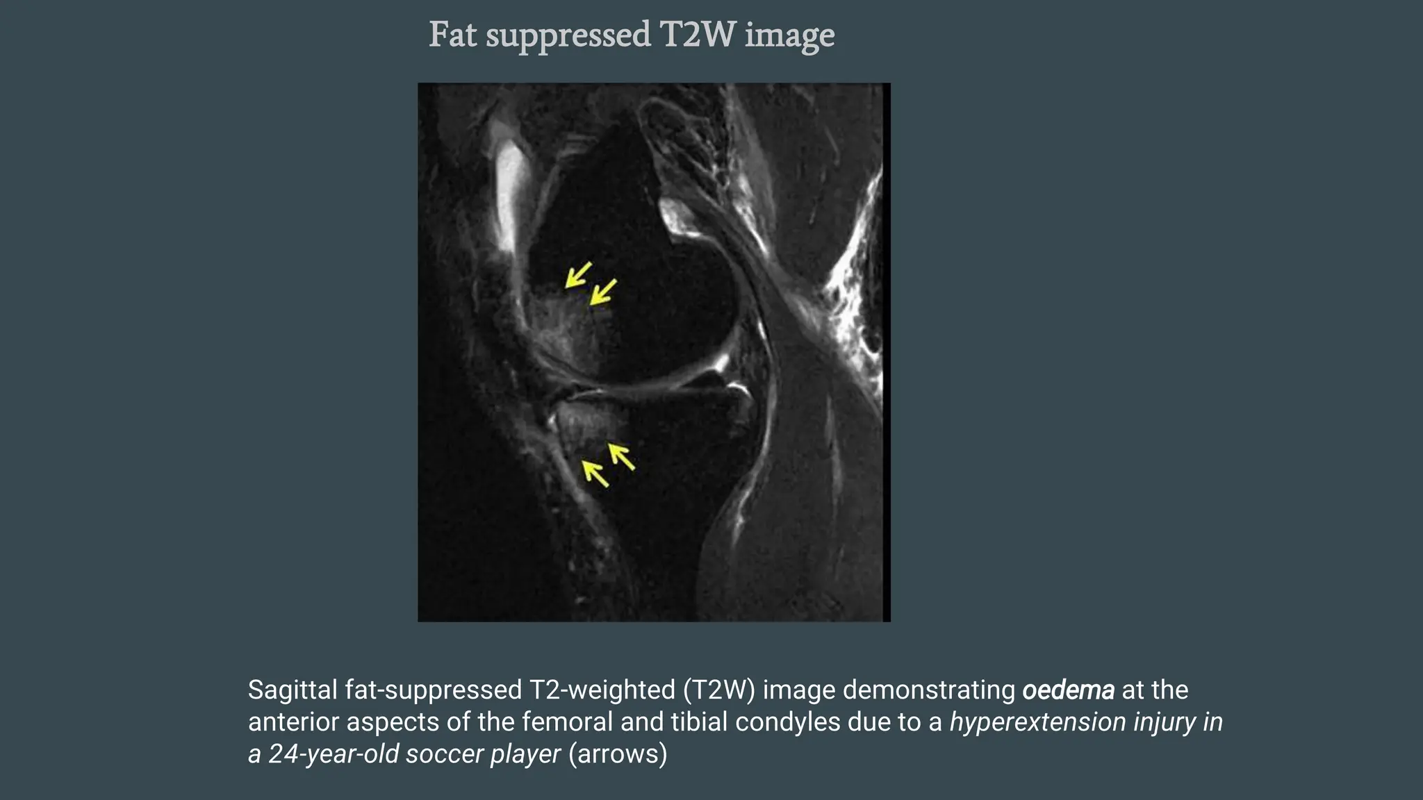mri in orthopaedics its importance and understanding | PPTX