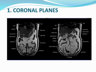 MRI Abdomen ( Dynamic Study - Tri-phasic of Liver ) | PPTX