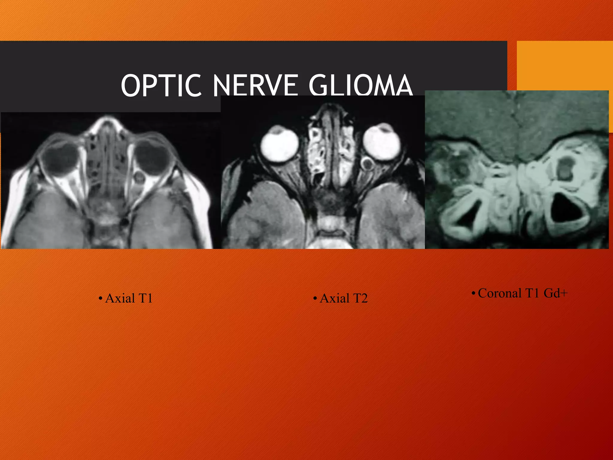 MRI Abnormalities.pptx