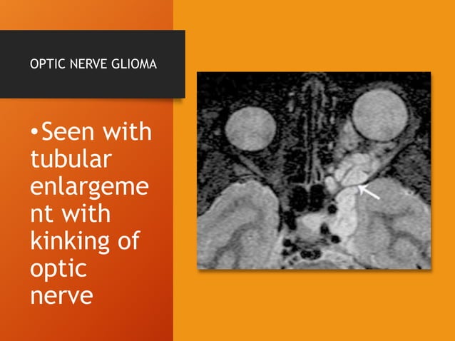 MRI Abnormalities.pptx