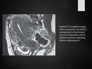 mri adenomyosis.pptx