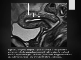 mri adenomyosis.pptx