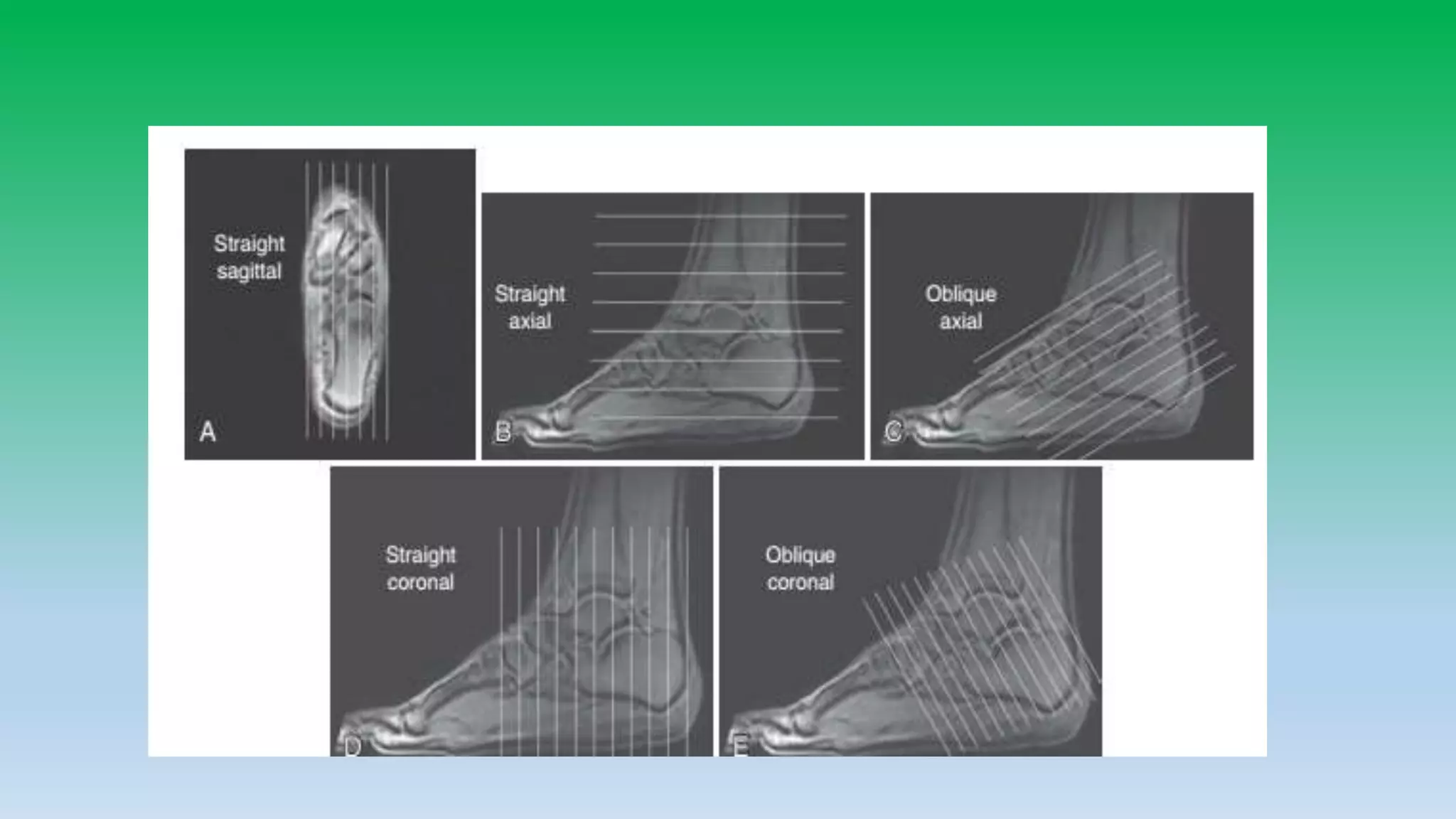 Mri anatomy of ankle radiology ppt pk | PPTX