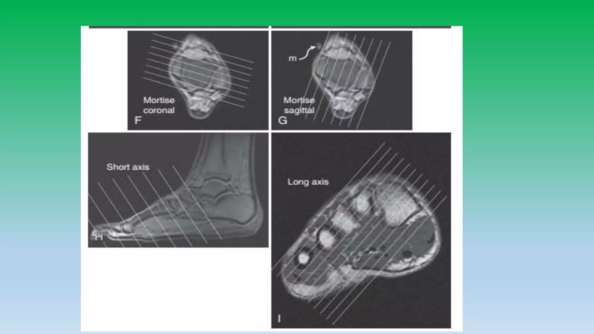 Mri anatomy of ankle radiology ppt pk | PPTX
