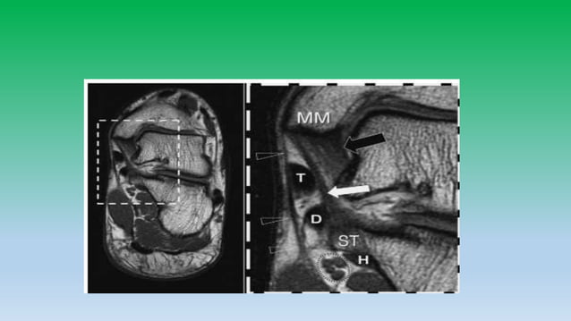 Mri anatomy of ankle radiology ppt pk | PPTX
