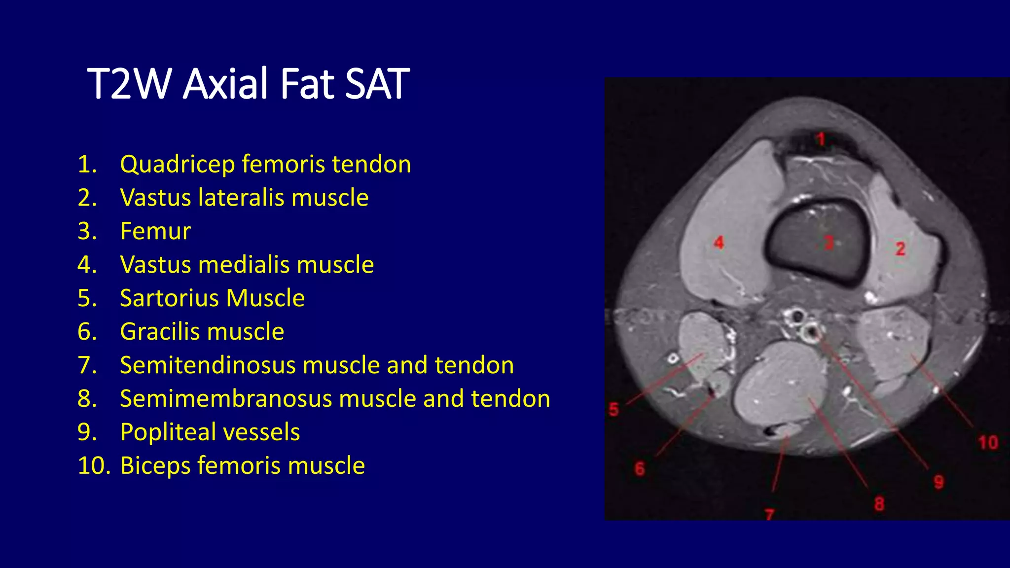 Mri anatomy of knee Dr. Muhammad Bin Zulfiqar | PPTX