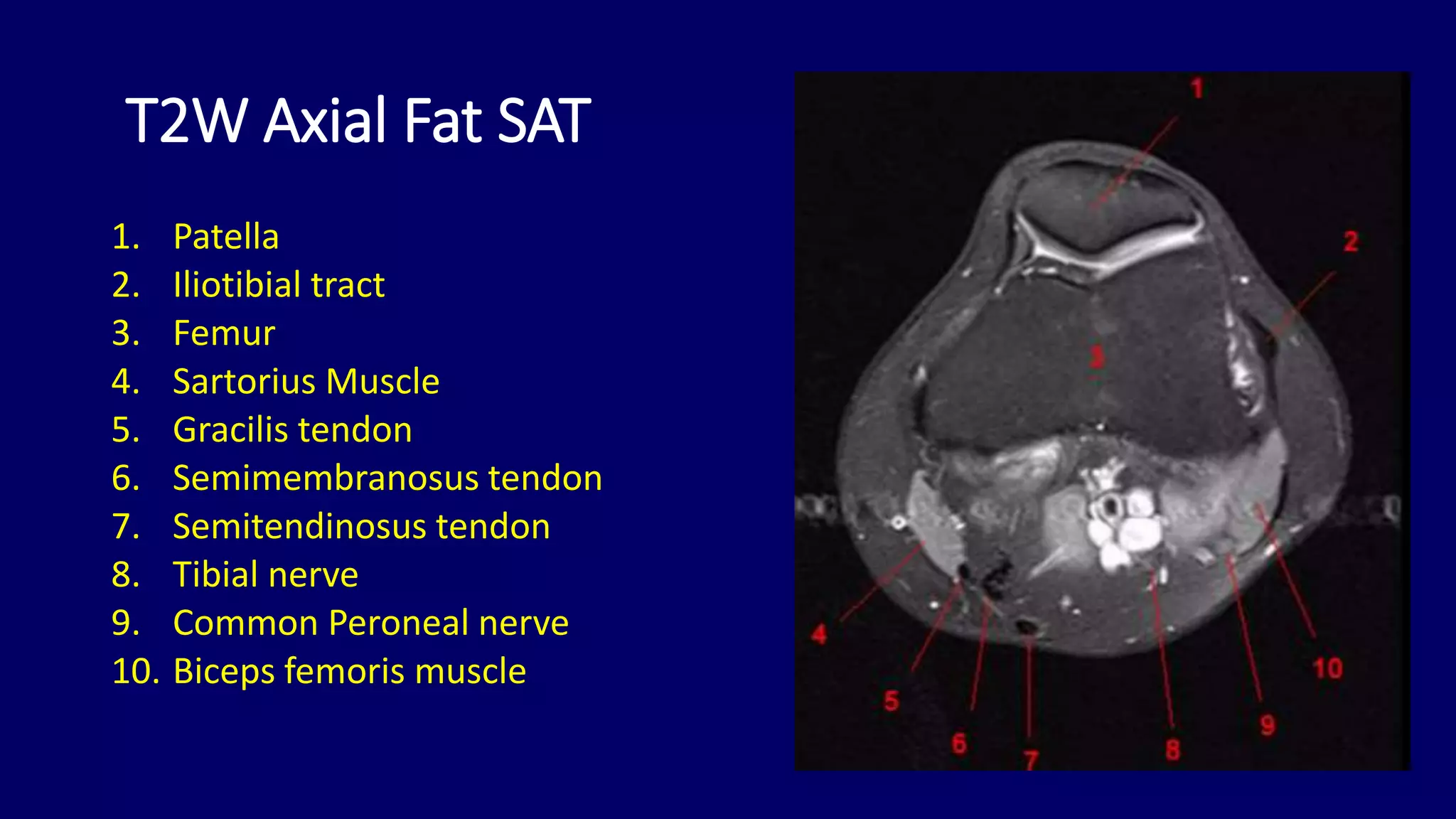 Mri anatomy of knee Dr. Muhammad Bin Zulfiqar | PPTX