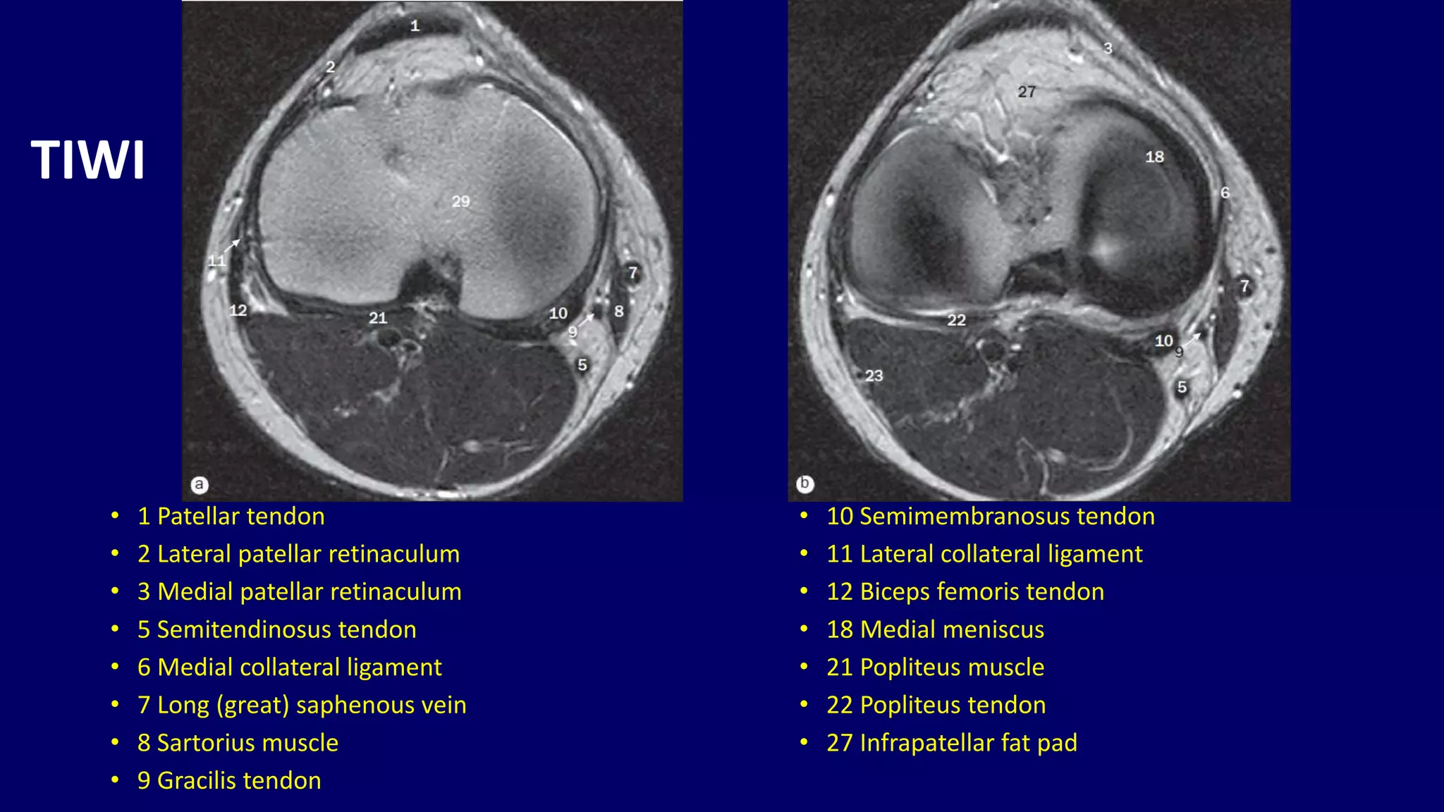 Mri anatomy of knee Dr. Muhammad Bin Zulfiqar | PPTX