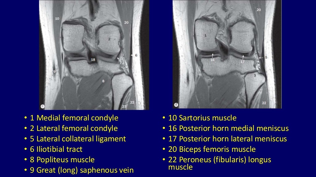 Mri anatomy of knee Dr. Muhammad Bin Zulfiqar