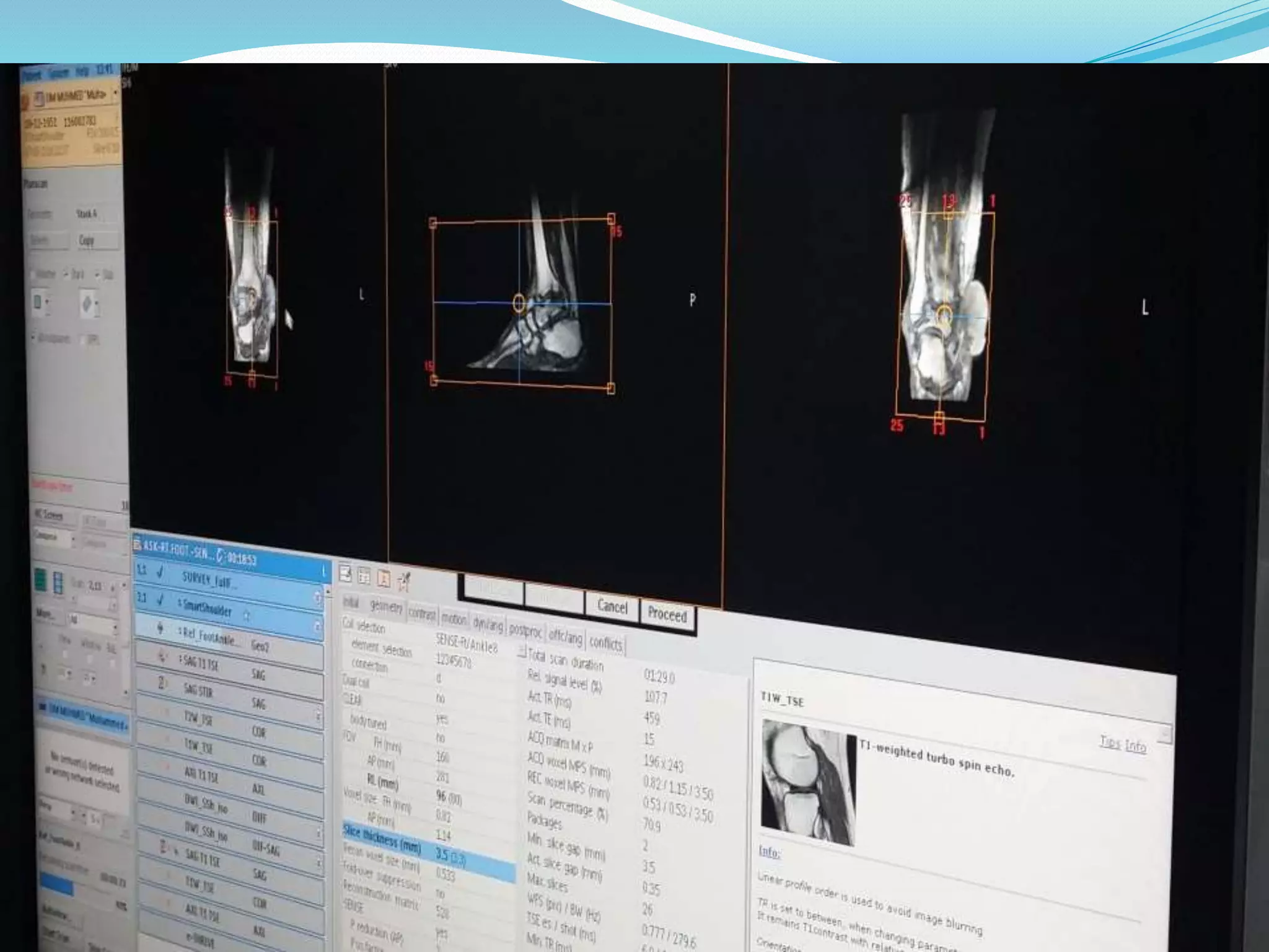 MRI- ankle techniques | PPTX