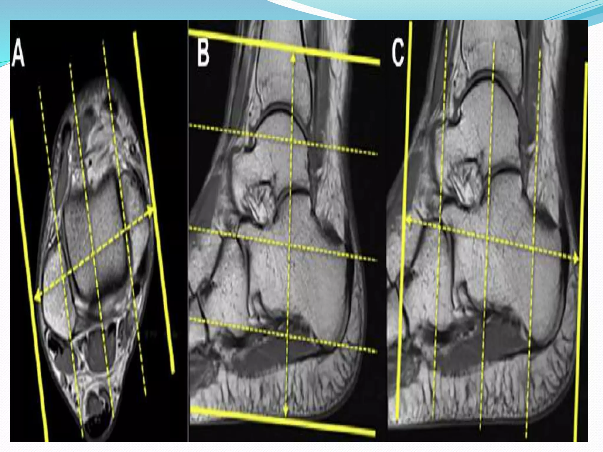 MRI- ankle techniques | PPTX