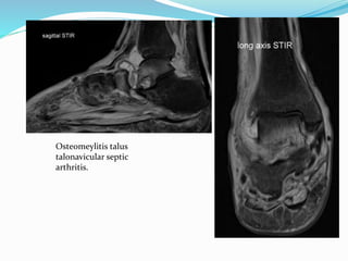 MRI- ankle techniques | PPTX
