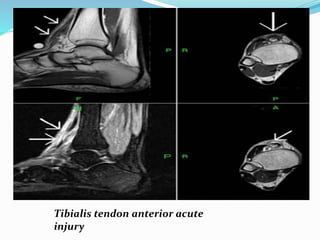 MRI- ankle techniques | PPTX