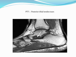 MRI- ankle techniques | PPTX