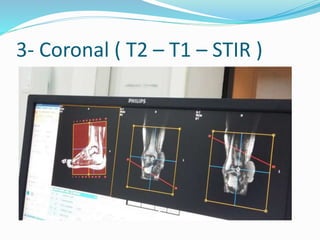 MRI- ankle techniques | PPTX