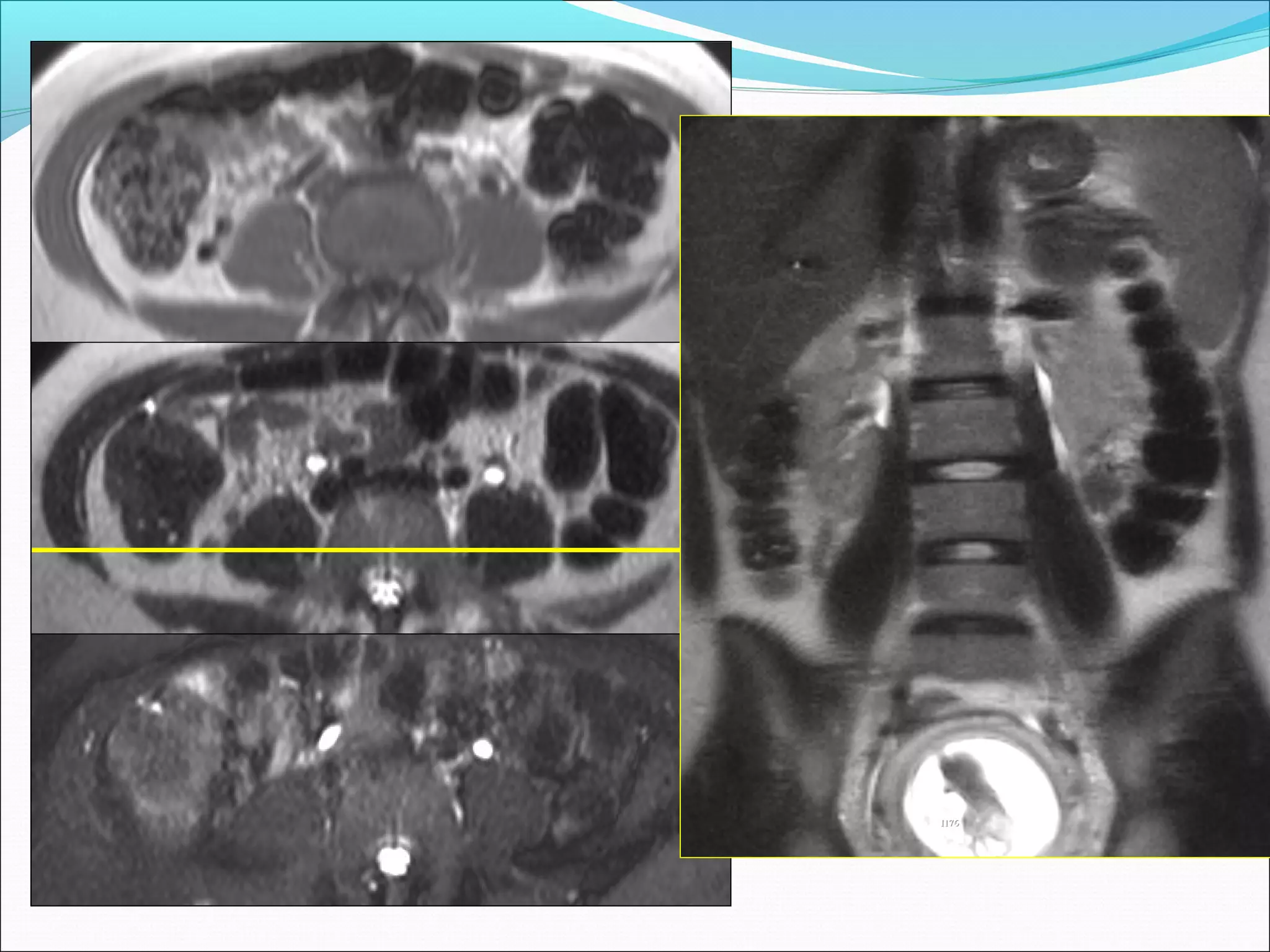 Mri appendicitis | PPT