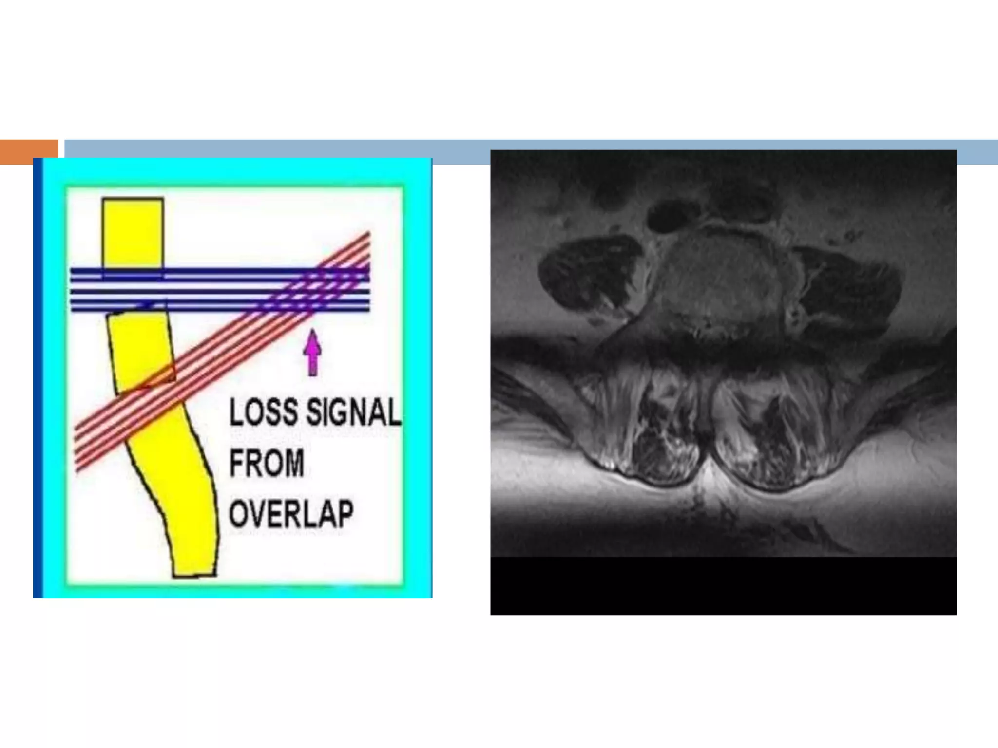 Mri artifacts | PPTX