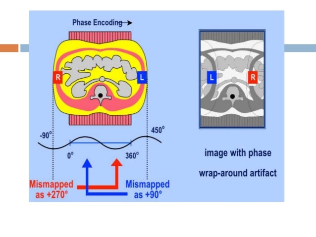 Mri Artifacts