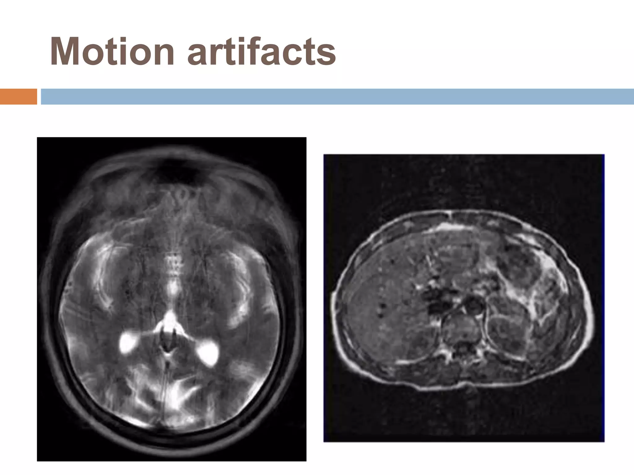 MRI Artifacts | PPTX