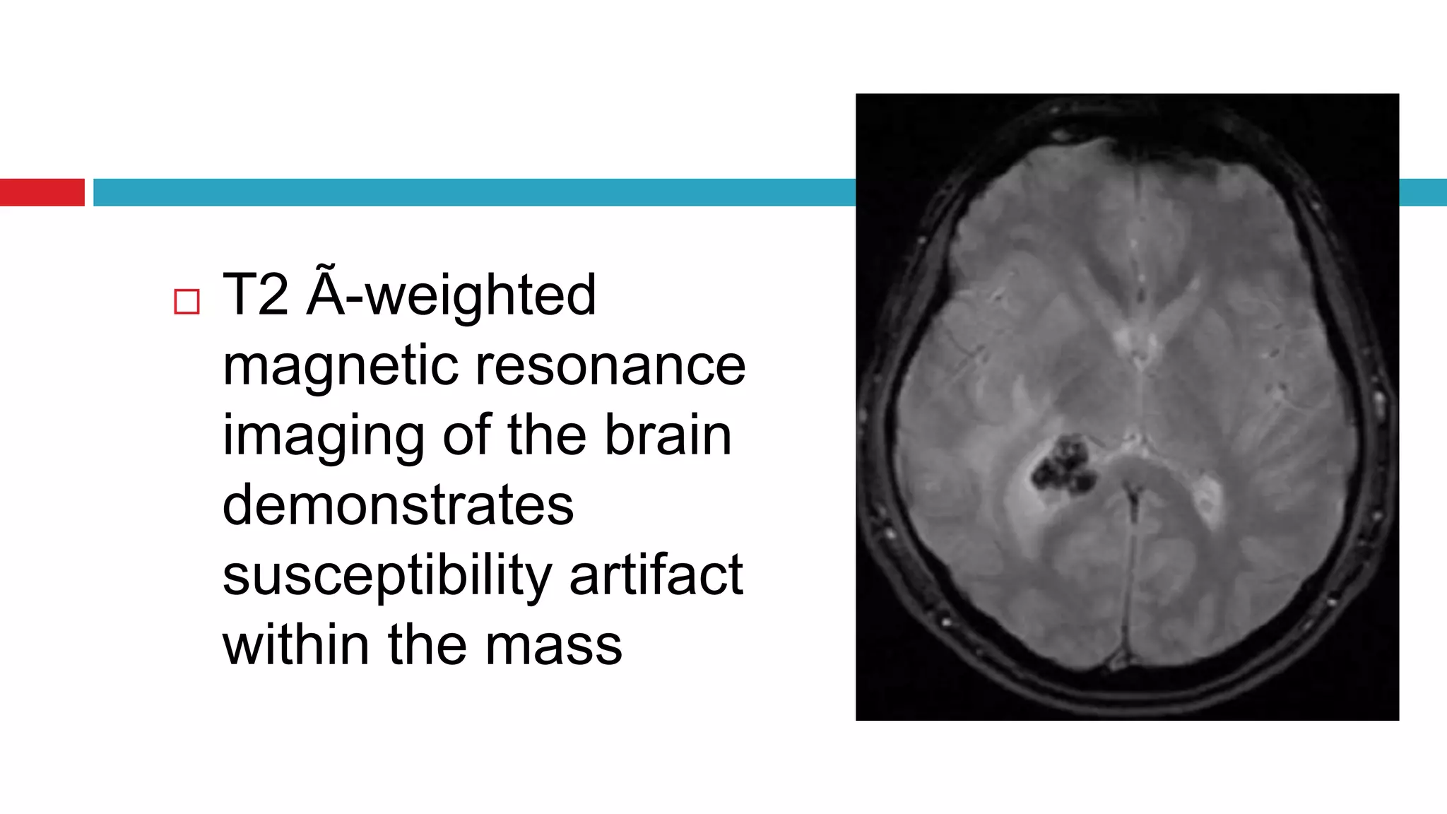 MRI Artefacts | PPTX