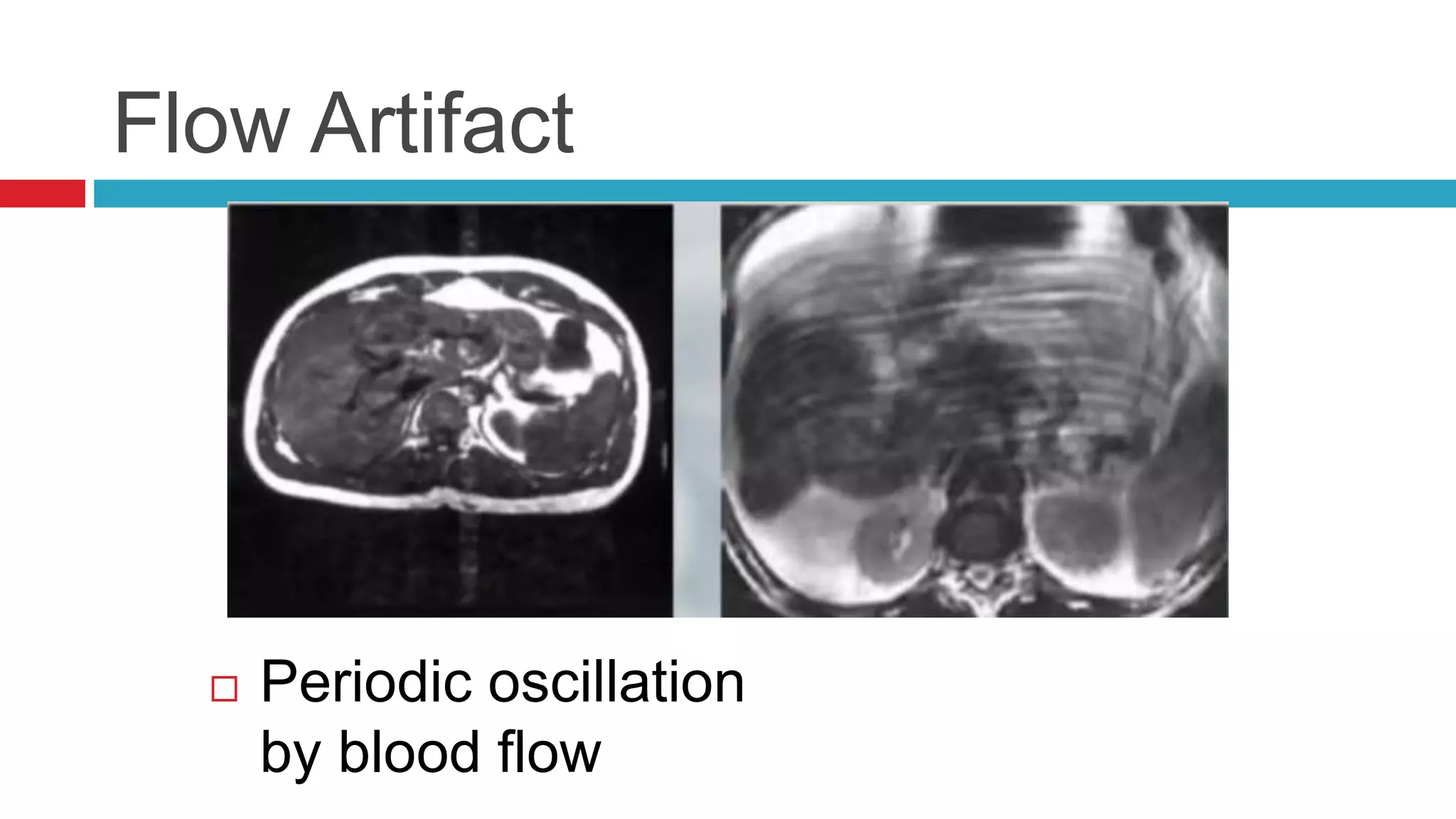 MRI Artefacts | PPTX