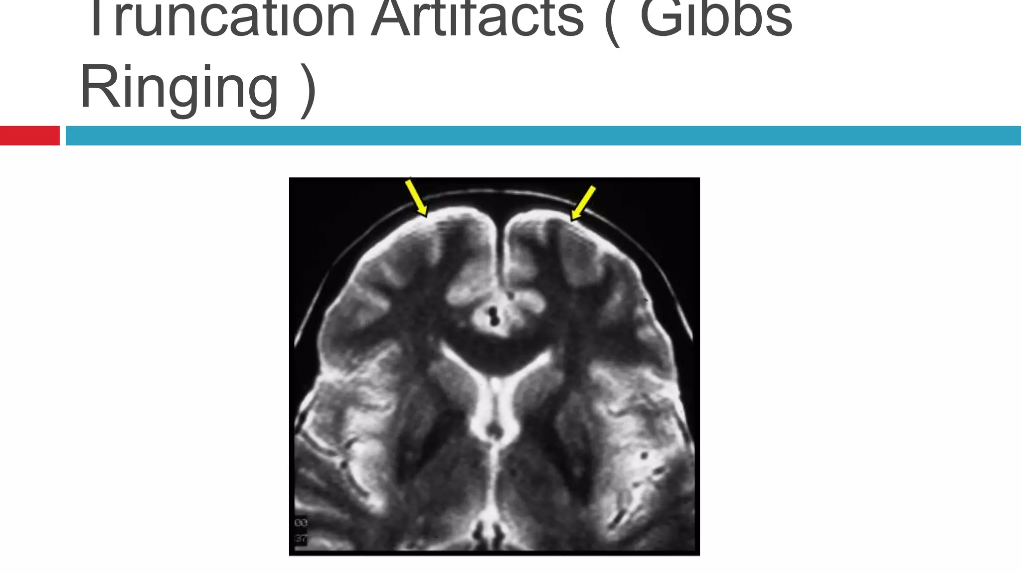 MRI Artefacts | PPTX