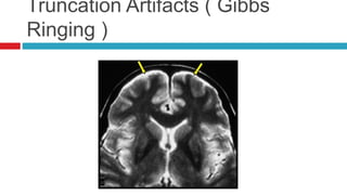 MRI Artefacts | PPTX