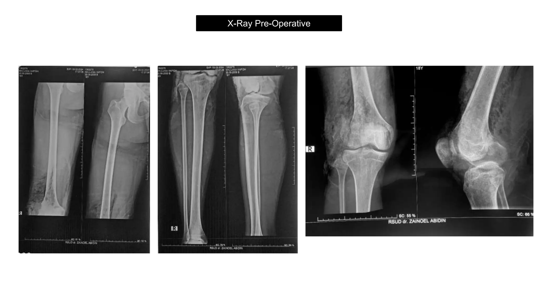MR IAZ-MRZ finger tip injury left middle finger.pptx