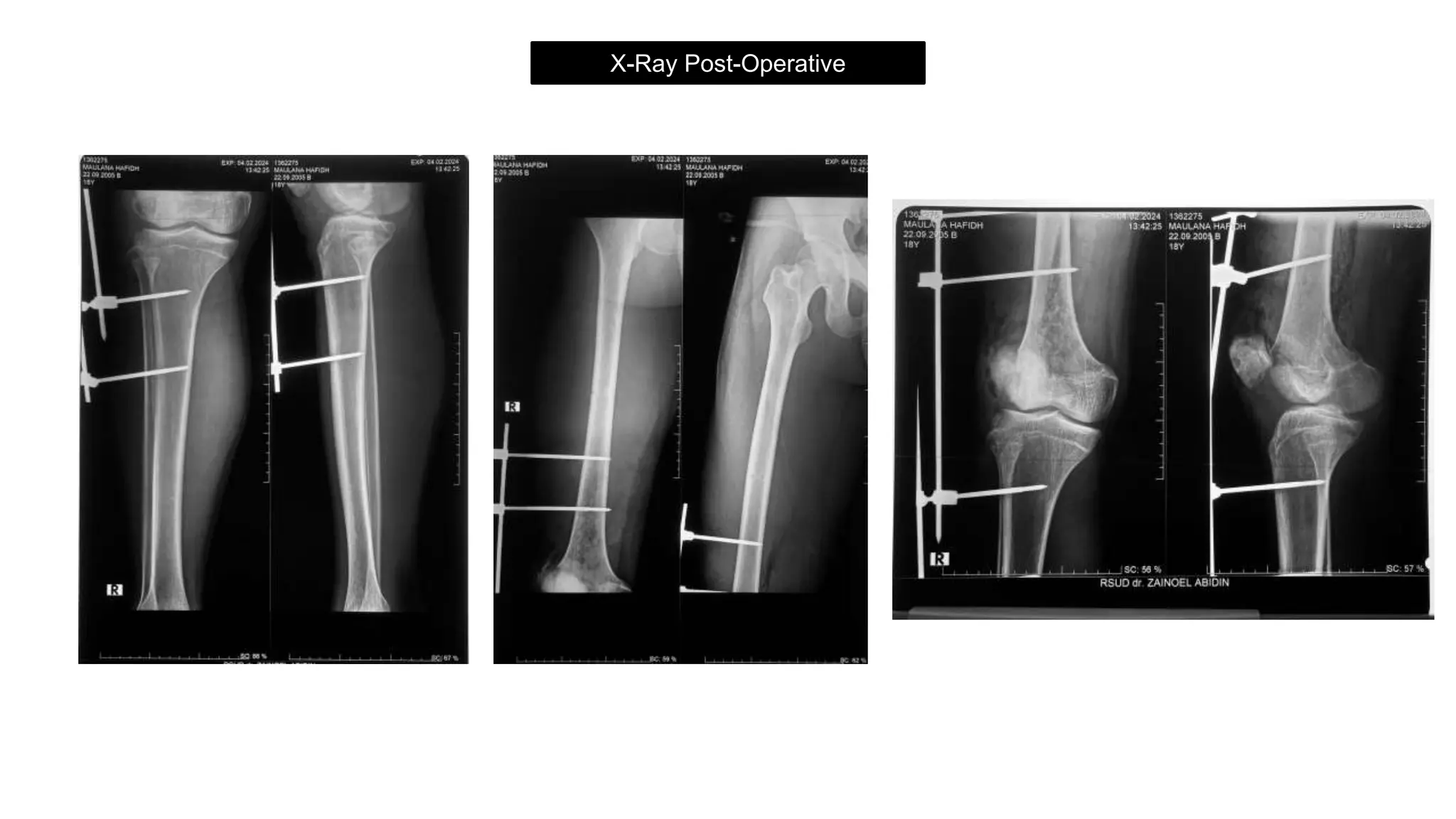 MR IAZ-MRZ finger tip injury left middle finger.pptx