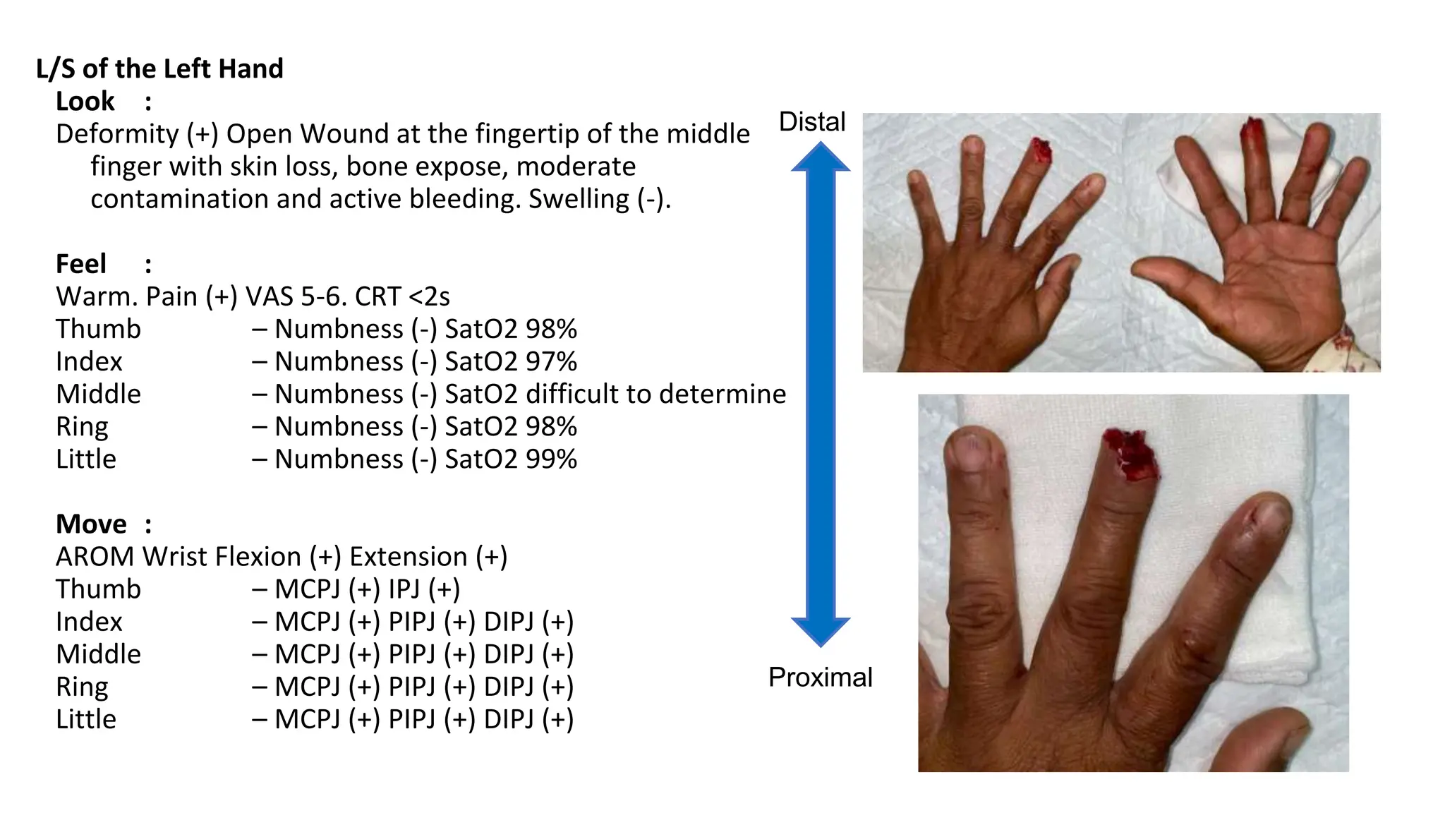 MR IAZ-MRZ finger tip injury left middle finger.pptx