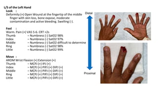 MR IAZ-MRZ finger tip injury left middle finger.pptx
