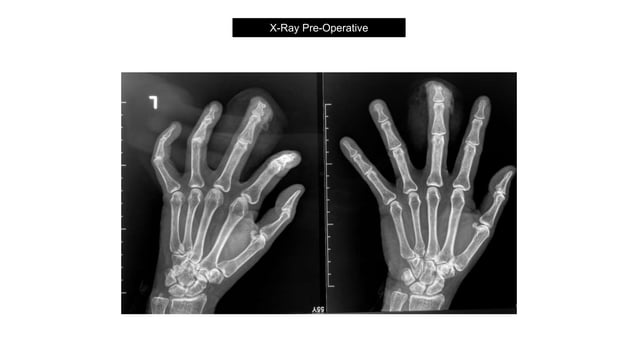 MR IAZ-MRZ finger tip injury left middle finger.pptx