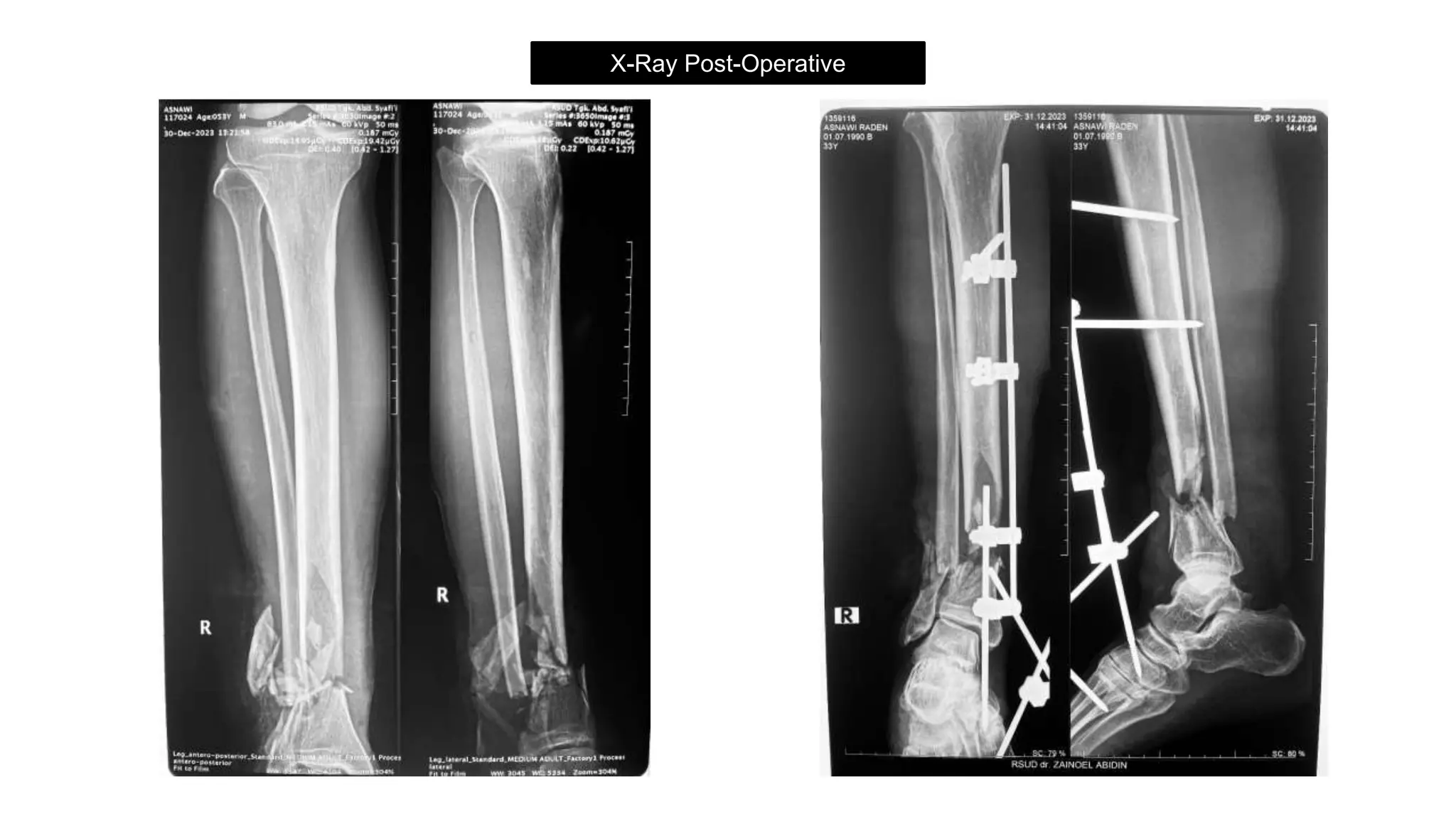 MR IAZ open fracture comminutive fracture of left distal tibia.pptx