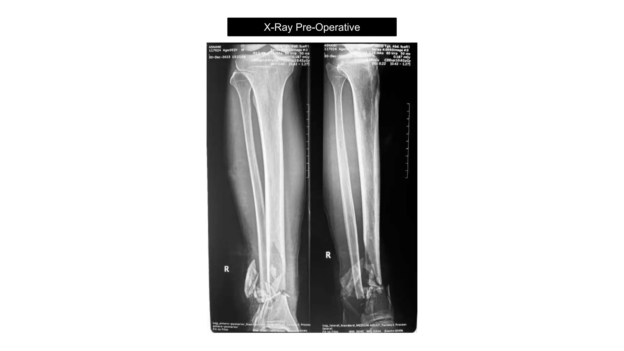 MR IAZ open fracture comminutive fracture of left distal tibia.pptx