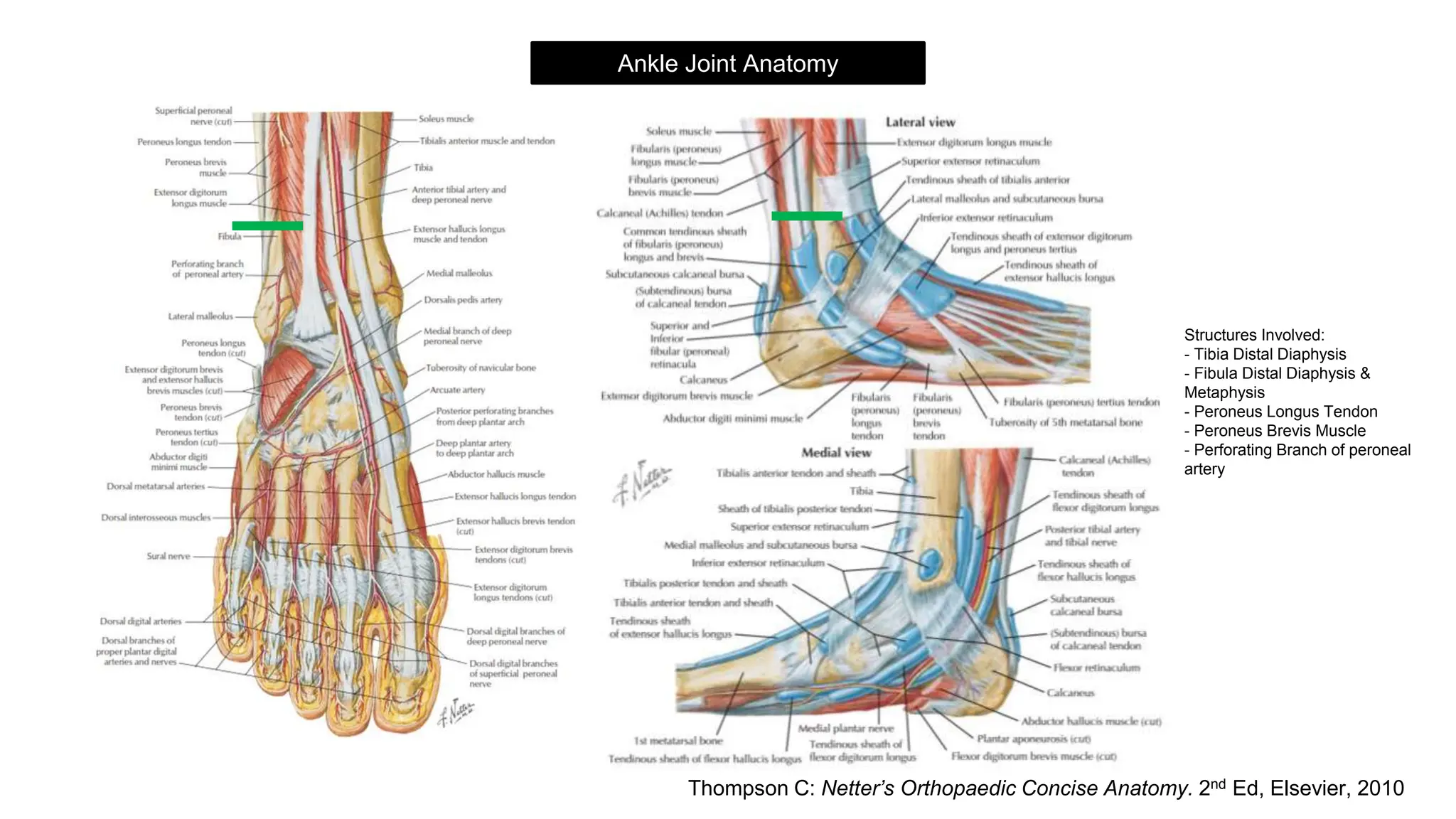 MR IAZ open fracture comminutive fracture of left distal tibia.pptx