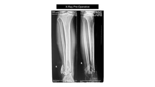 MR IAZ open fracture comminutive fracture of left distal tibia.pptx