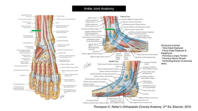 MR IAZ open fracture comminutive fracture of left distal tibia.pptx